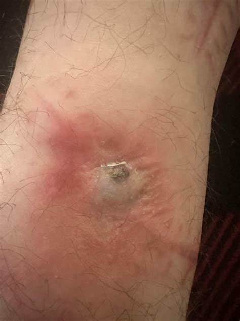 Does This Scar Look Normal R Scars