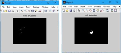 Automated Diabetic Retinopathy Detection System