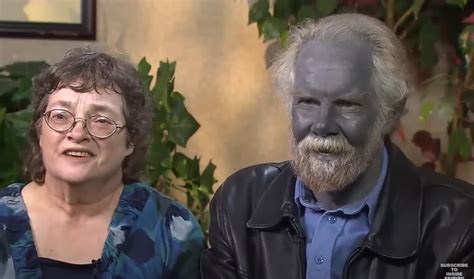 Real Life ‘papa Smurf Man Turned Blue After Being Born Fair Skinned With Reddish Blond Hair
