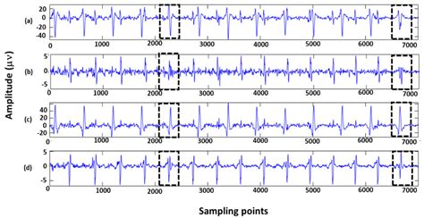Sensors Free Full Text Fetal Electrocardiogram Signal Extraction