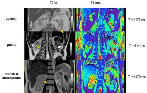 T 1 Maps In Patients With Rcc Obtained Using A Vfa Mapping Technique Download Scientific