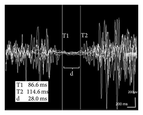 A CSP Recording From APB Muscles In Control Subject B In Download Scientific Diagram