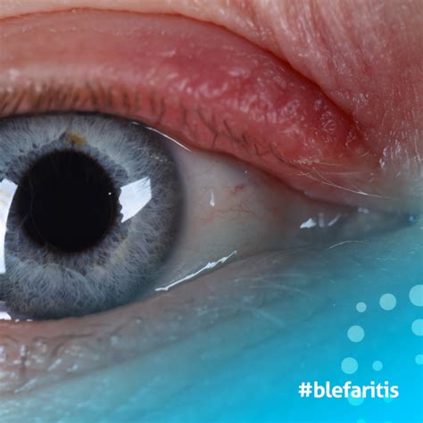Blefaritis Síntomas Causas Y Tratamientos