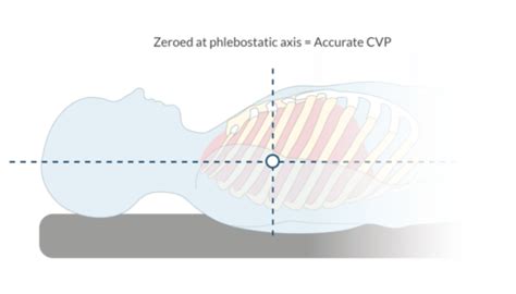 Cvp Interpretation And Abnormal Cvp Flashcards Quizlet