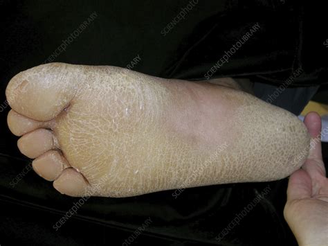 Plantar Keratoderma Stock Image C060 7989 Science Photo Library