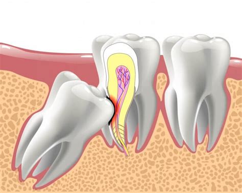 Impacted Wisdom Tooth Symptoms Causes And Treatment