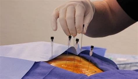 Medial Branch Block Diagnostic Injection
