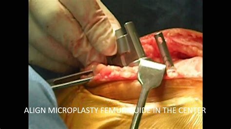 Oxford Partial Knee Replacement Surgery Using Microplasty Instrument By Dr P V Kailey Youtube