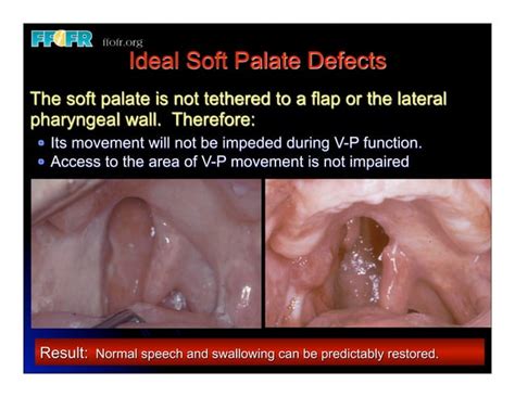 20 New Restoration Of Soft Palate Defects Pdf Ear Nose And