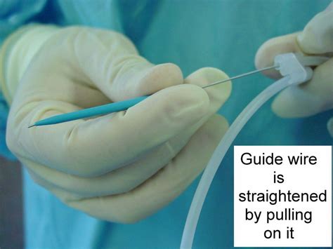 CasesBlog Medical And Health Blog Central Line Placement Procedure Guide