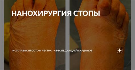 НАНОХИРУРГИЯ СТОПЫ О СУСТАВАХ ПРОСТО И ЧЕСТНО ортопед Андрей Карданов Дзен