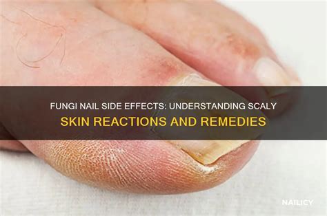 Fungi Nail Side Effects Understanding Scaly Skin Reactions And