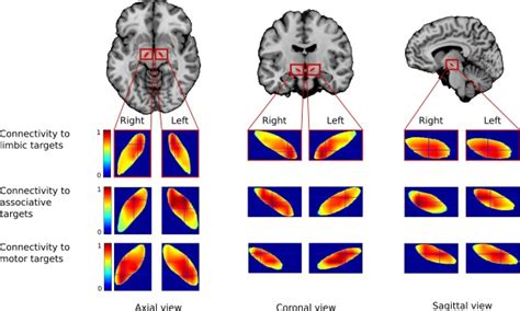Representation Of Averaged N 13 Subthalamic Nucleus—stn