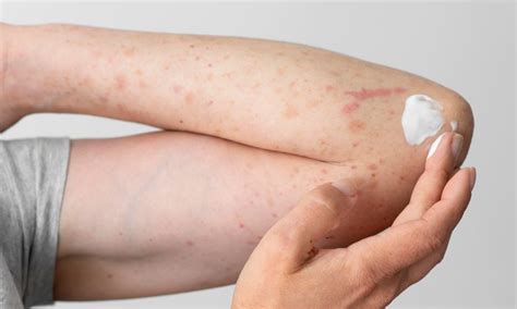 Lưu ý Sử Dụng Thuốc Trị Nấm Nizoral Cream 10g Tập đoàn Y Khoa Hoàn Mỹ