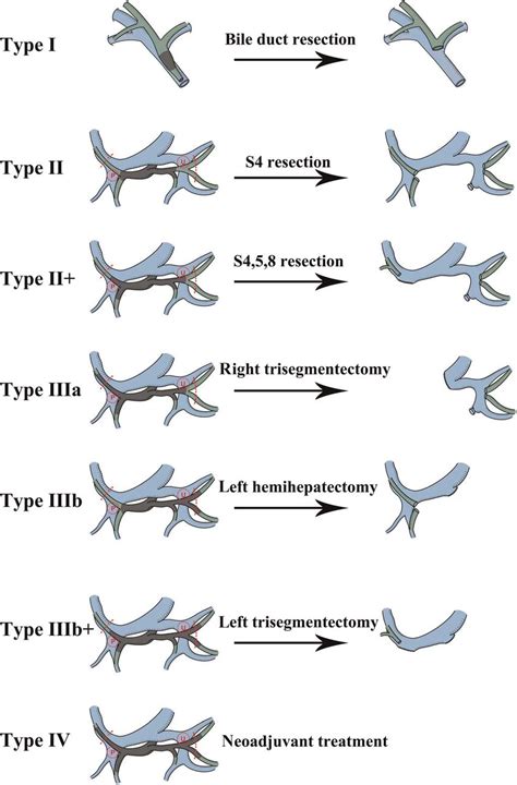 Modified Classification Of Hilar Cholangiocarcinoma And The