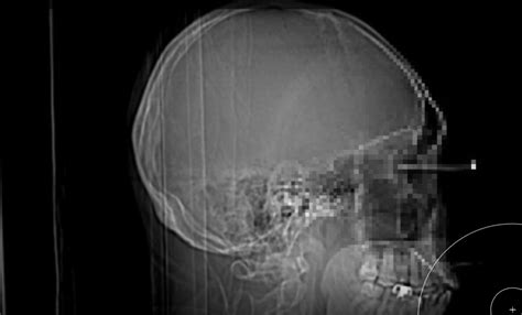 驚悚！高雄男右眼遭鐵釘貫穿 醫揭恐怖後果 鏡週刊 Mirror Media