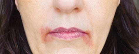 Perioral Dermatitis The Skin Care Clinic