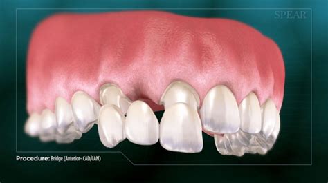 Spear Releases Two Anterior Bridge Patient Education Videos Spear