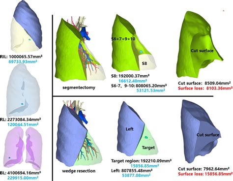 Segmentectomy Or Wedge Resection Of Rs8 Download Scientific Diagram
