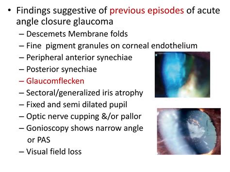 Acute Glucomapptx