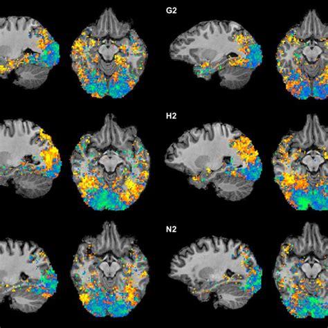 Ventral Occipitotemporal Cortex The Anatomical Region Containing