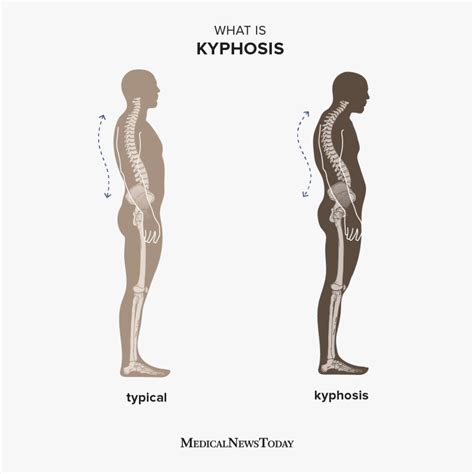 Cervical Kyphosis Exercises