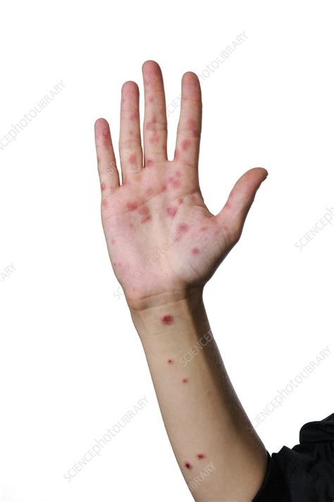 Erythema Hands