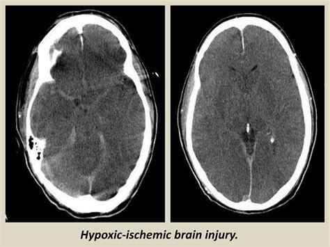 Presentation1 Pptx Radiological Imaging Of Peri Natal Acute Ischemia