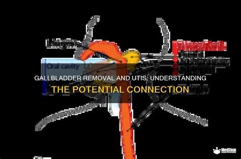 Gallbladder Removal And Utis Understanding The Potential Connection