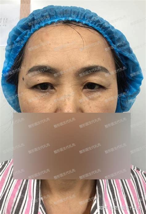 北京面部提升医生代礼先医生谈提眉手术也被大家叫做眼周小拉皮改善上睑松弛下垂三角眼 知乎