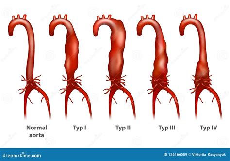 Abdominal Aortic Aneurysm Vector Illustration 49381632