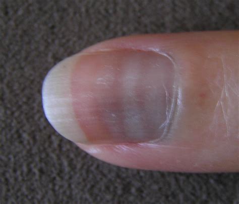 White Spots On Nails Causes Prevention And Treatment