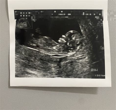 임신 12주차 1차 기형아 검사 비용 성별 입체 초음파 삼성미즈산부인과 네이버 블로그