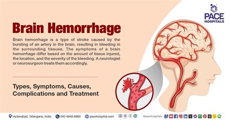 Brain Hemorrhage Causes Symptoms Types Treatment