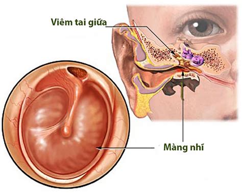 Can Otitis Media Cause Perforation Of The Eardrum Vinmec