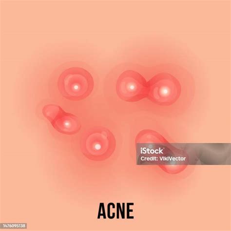 Ilustración De Acné Piel Granos Cosmetología Esquema Médico Enfermedad