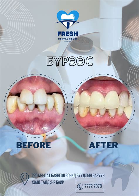 Fresh Шүд бол эрүүл гоо үзэмж гээд олон зүйлсийг илэрхийлдэг эрхтэн юм Бид шүдний гэмтэлтэй