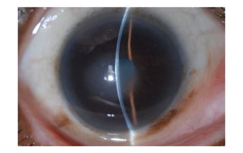 Fuchs Endothelial Dystrophy