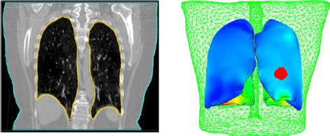 Patient Specific Finite Element Model Based On The Ct Image Data Each Download Scientific