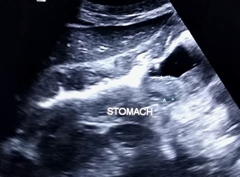 Gastritis Diffuse Homogenous And Ultrasound Precision Facebook