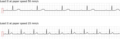 First Degree Av Block Av Block I Av Block 1 Ecg Learning