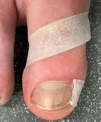 How To Treat Ingrown Nail Dermatology Games