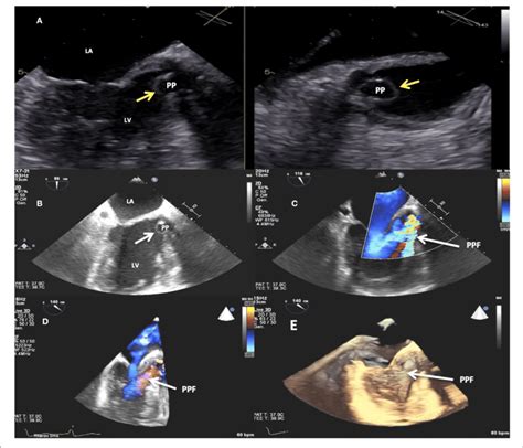 Transesophageal Echocardiogram Tee 2d Imaging Showing The