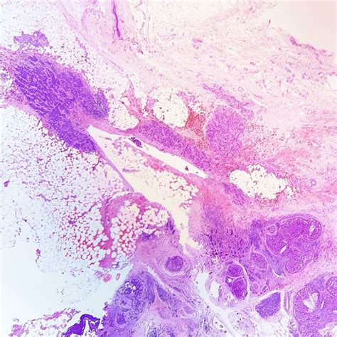 Histological Section From Quadrantectomy Specimen Showing Fibrous