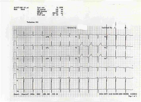 Left Anterior Fascicular Block MDNotes