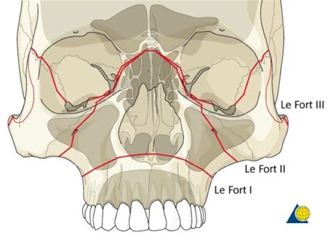 Maxillofacial Trauma Maxillary Fractures