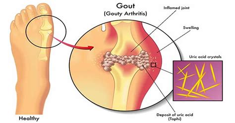 Uric Acid Test Level High Uric Acid Causes Symptoms Treatment