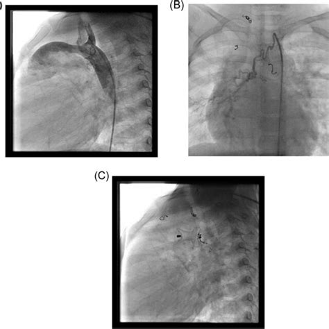 Type Of Pda Based On The Krichenko Classification Download Scientific Diagram