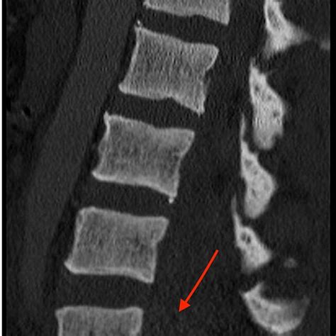 Ct Lumbar Spine Sagittal Sequence At Initial Presentation Demonstrating Download Scientific