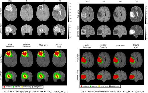Figure 4 From Attention Guided Version Of 2d Unet For Automatic Brain Tumor Segmentation